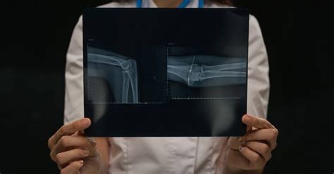 Osteoporosis Epidemia Silenciosa Y Costosa