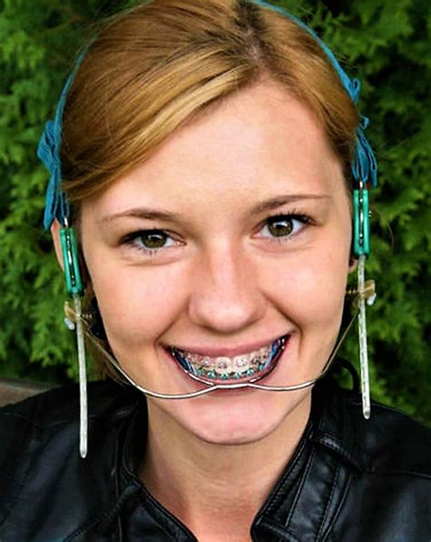 Pin By Randal Tucker On Orthodontic Headgear Braces Braces Girls Dental Braces Orthodontics
