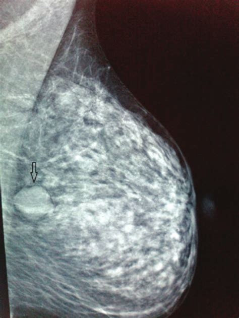 Left Mediolateral Oblique Mammogram Shows A Multilobulated