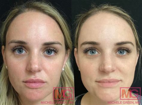 Bruising After Cheek Fillers Causes And Prevention