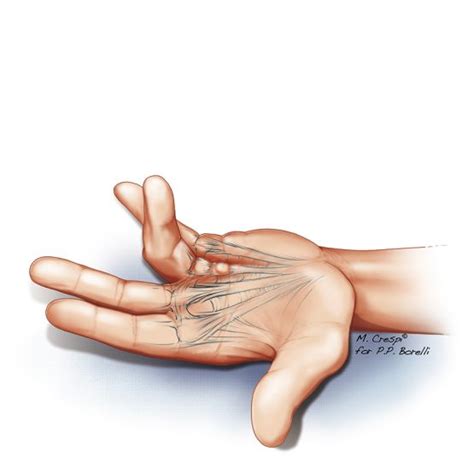 La Malattia Di Dupuytren E Lanatomia Della Mano Chirurgia Della Mano Brescia