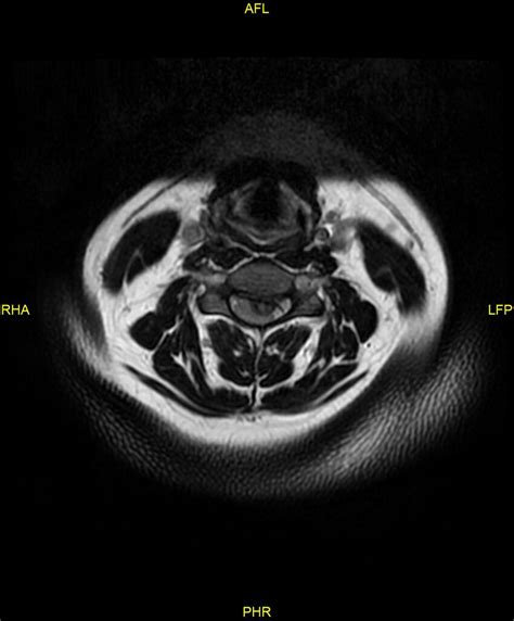 Cervical Disc Protrusion Radiopaedia 87147 103415 Axial T2 Nc Commons