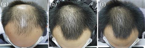 Does Finasteride Work For A Receding Hairline Wimpole Clinic