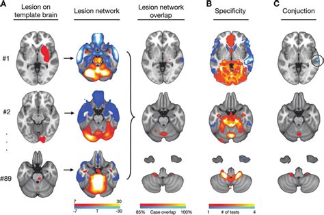 Lesion Network Mapping Of Hallucinations A Each Of Our 89 Lesion