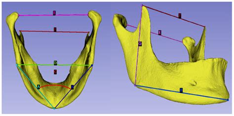 The Accuracy Of Sex Identification Using Cbct Morphometric Measurements