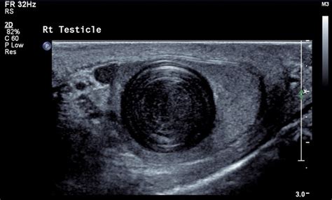 Cisto Epidermoide Testicular