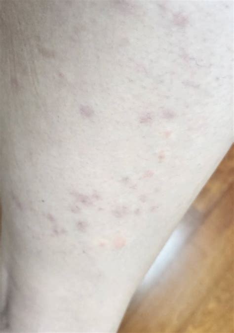 몸에 두드러기 나는데 원인 아는 사람 ㅠㅠ 사진있음 인스티즈 Instiz 일상 카테고리