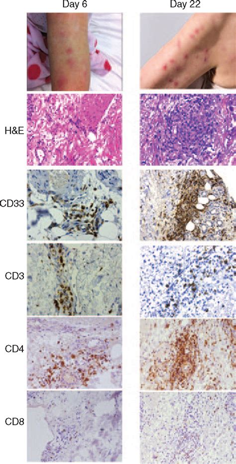 Persistence And Efficacy Of Second Generation Car T Cell Against The