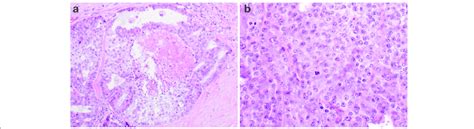 A Neoplasm Is Comprised Of Cribriform Growth Pattern With Central