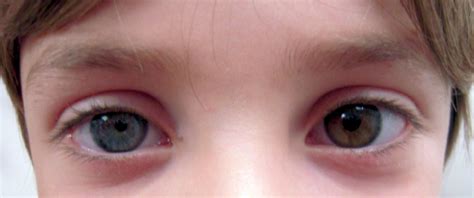 How Rare Is Anisocoria At Anglea Ramos Blog