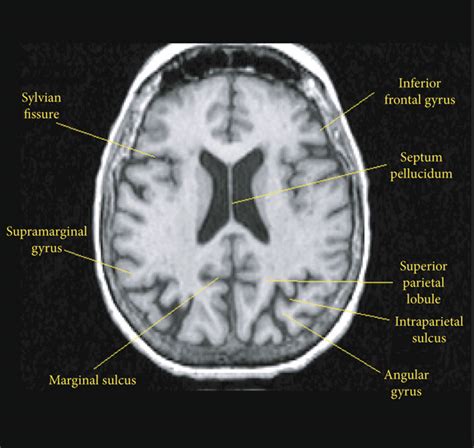 Septum Pellucidum Mri
