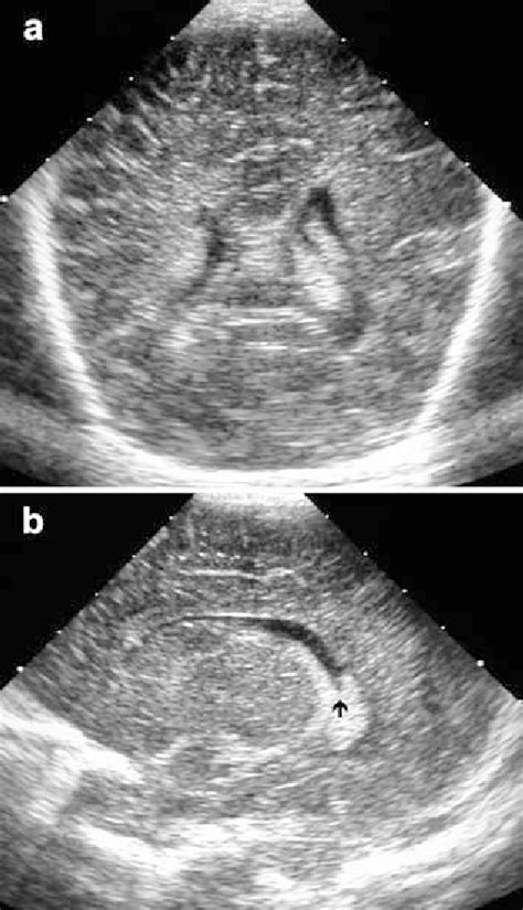 A B Split Choroid Plexus A Coronal View In A Full Term Newborn Download Scientific
