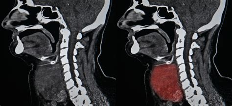 What Is A Thyroid Gland Ct Scan Two Views