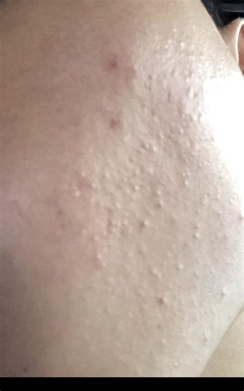 Acne Is This Closed Comedones Or Fungal Acne Im Getting More And