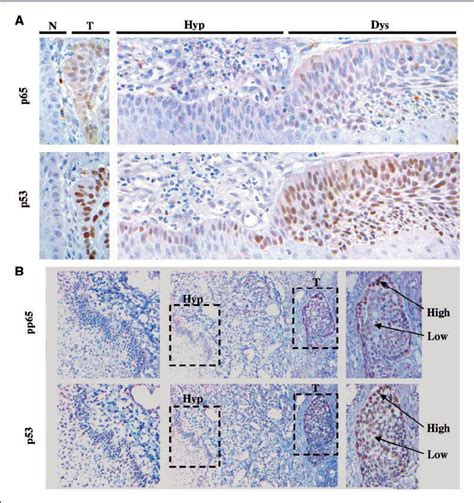 Mutant P53 Overexpression Coincides With Nf N B Activation In Human