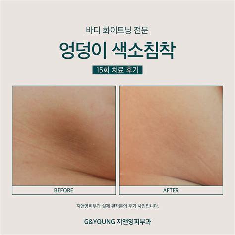 지앤영피부과 엉덩이색소침착 치료후기 엉덩이 색소침착으로 고민하시다가 지앤영피부과