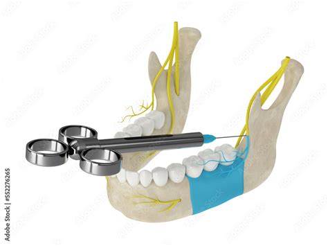 Buccal Dental Block At Joshua Allingham Blog