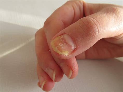 Unhealthy Nails