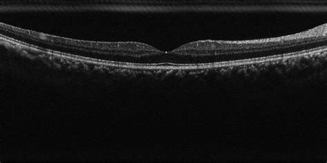 retinal detachment object detection dataset and pre trained model by