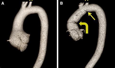 Hemiarch Replacement A Pre Operative Imaging Demonstrates Dilatation
