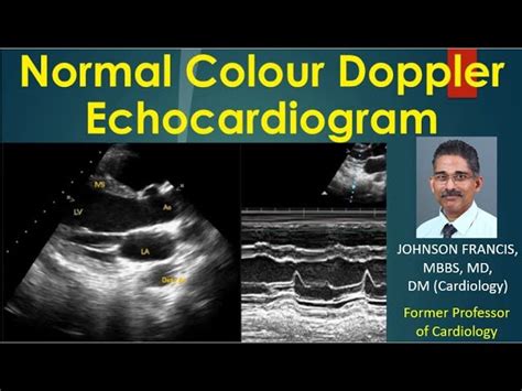 Normal Echocardiogram