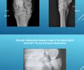 Splint Bone Proximal Sesamoid Bone Fractures Flashcards Quizlet