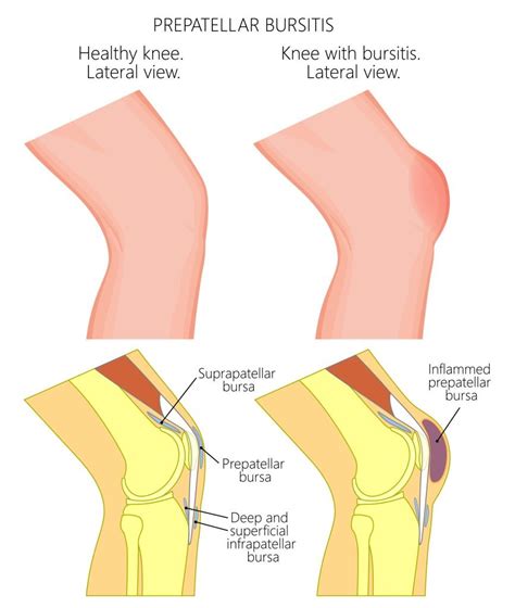 Prepatellar Bursitis Physioflow Pt Physical Therapy Vancouver Wa