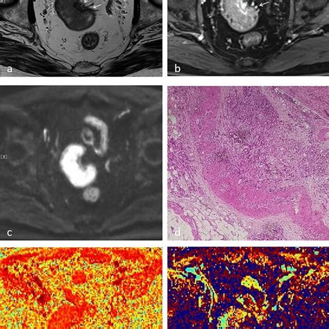 A 68 Year Old Male With Rectal Adenocarcinoma A Mri T2wi Showed That