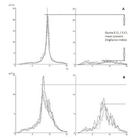 Eeg Variables For A Healthy Person And A Patient With Suspected Download Scientific Diagram