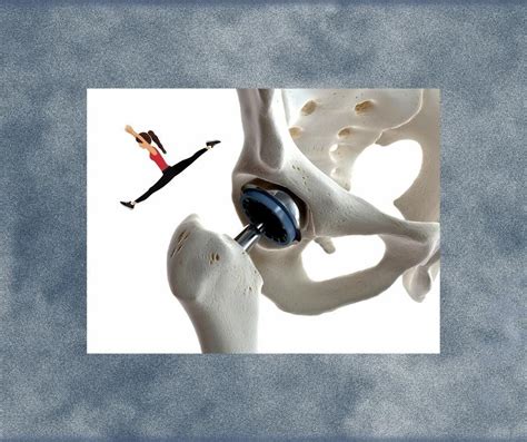 Is There Sex After Hip Replacement By Maddy Aramis Sexography Medium