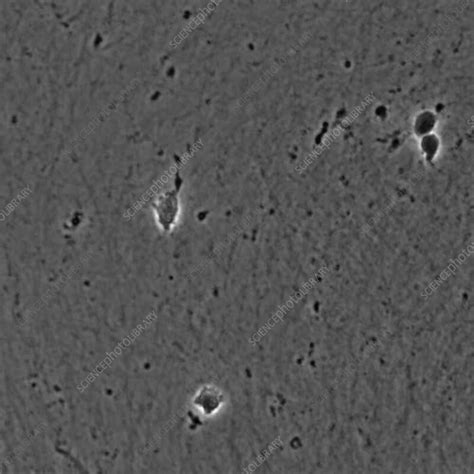 Ewing Sarcoma Cancer Cells Light Microscopy Stock Video Clip K013 0689 Science Photo Library