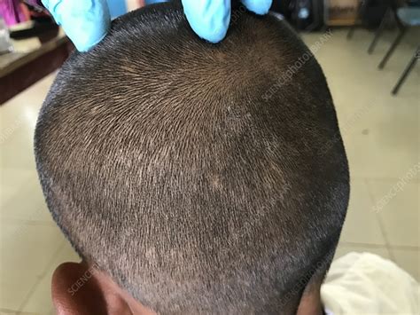 Ringworm On Scalp Tinea Capitis Scalp Ringworm Hse Ie