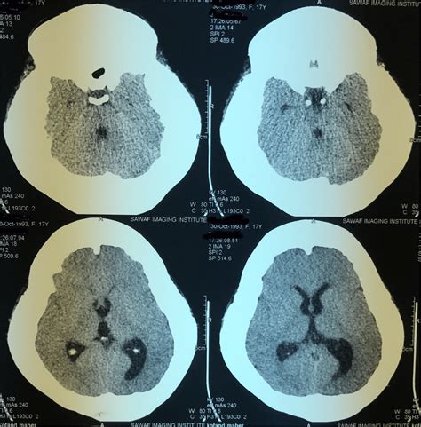 Ct Scan Of The Skull Showing Diffuse Skull Bone Thickening Download Scientific Diagram