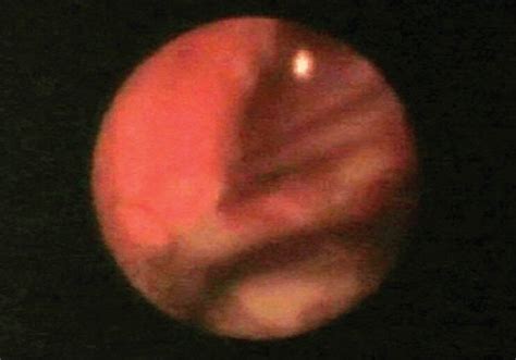 Endoscopic View Of The Osteotomy From The Nasal Side Two Silicone