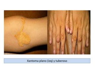 Xantomas Pptx
