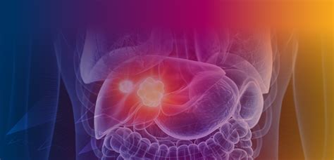 Updated Nccn Guidelines For The Treatment Of Advanced Or Recurrent Endometrial Cancer Onclive