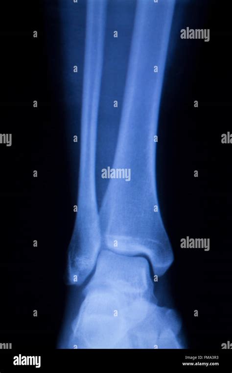 Shin Lower Leg And Ankle Injury Traumatology Medical X Ray Orthopedic