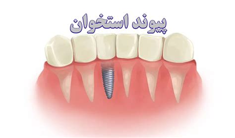 صفر تا 100 مراحل پیوند استخوان فک انواع پیوند استخوان