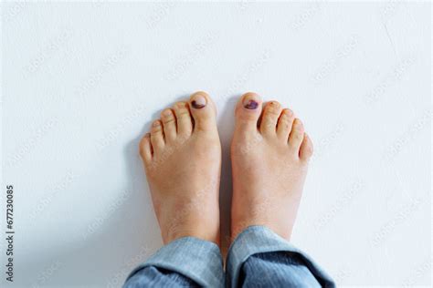 Tired Female Feet Barefoot With Bruise On Big Toe From Tight