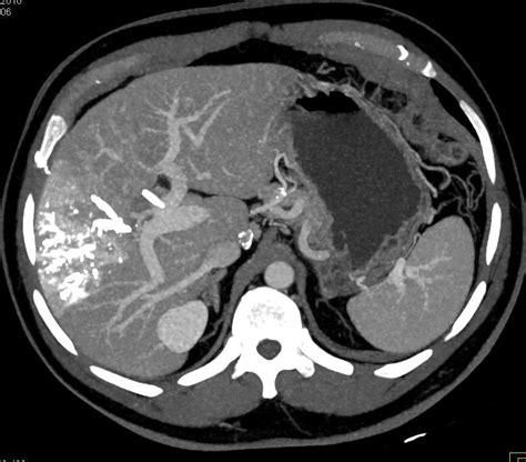 Embolization Of Venous Map Liver Liver Radiology Case Studies