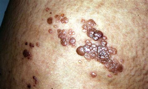 Facts About Lymphangioma