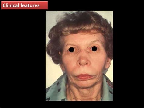 Bone Diseases 2014 Pptx