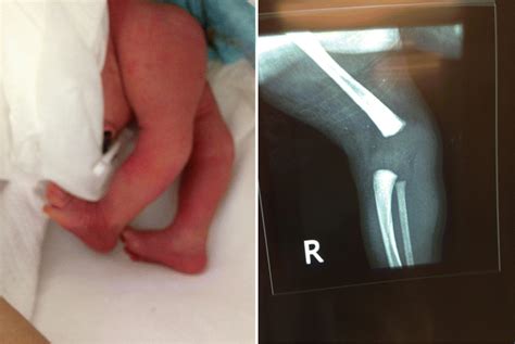 Congenital Knee Dislocation