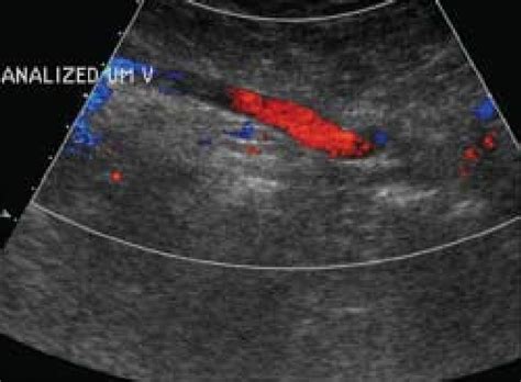 Paraumbilical Vein Ultrasound Imaging Approach To Portal Hypertension