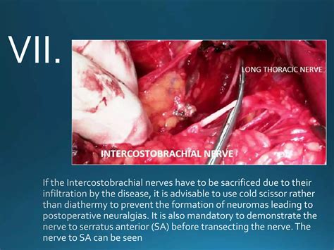 Modified Radical Mastectomy Pptx
