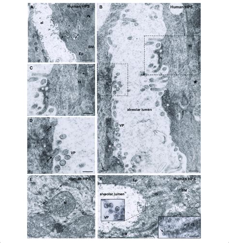 Transmission Electron Microscopy Of Human Lung From A Lethal Hps