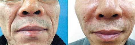 보톡스·필러 효과 없을땐 자가진피재생술 고려해 볼 만