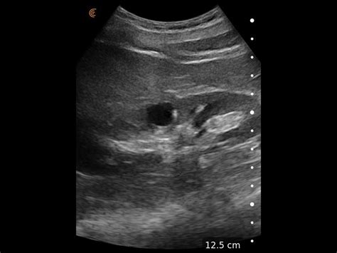 Renal Cyst Clarius