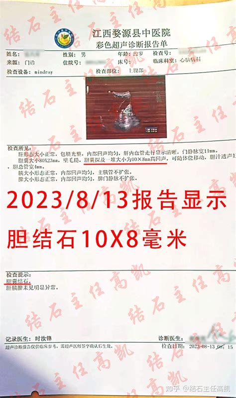 胆结石化小排出 知乎