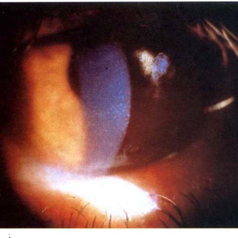 Severe Superficial Punctate Keratitis And Punctate Epi­ Thelial